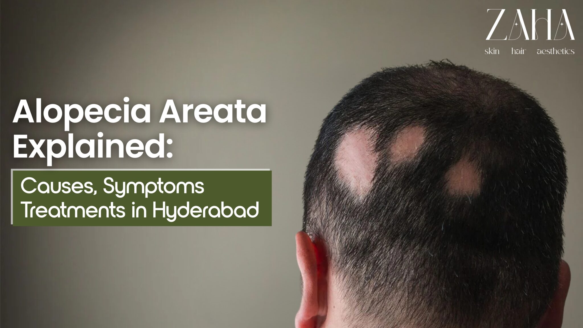Alopecia Areata Treatment in Hyderabad | Zaha Clinic
